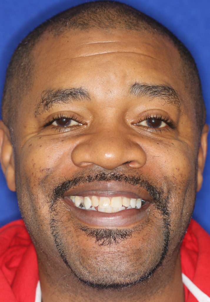 Smile Gallery – Smile Bond