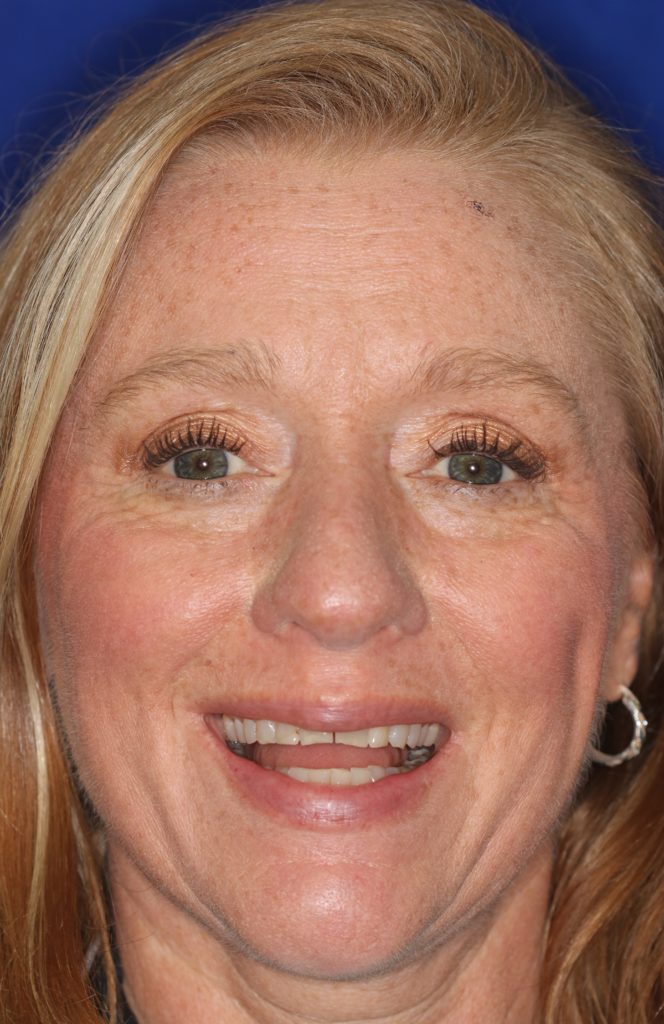 Smile Gallery – Smile Bond